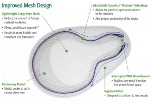 Modified Onflex Mesh for Preperitroneal Hernia | Medline