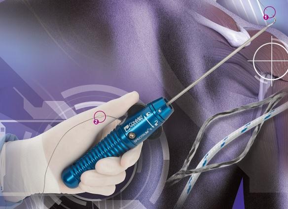 Conmed Super Shuttle Suture Passers | Medline